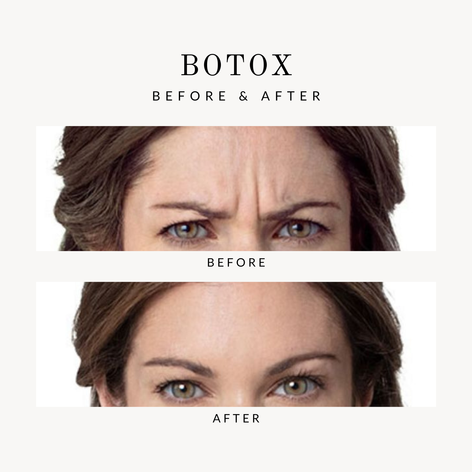 Botox, Dysport & Xeomin - Greenbrae Dermatology